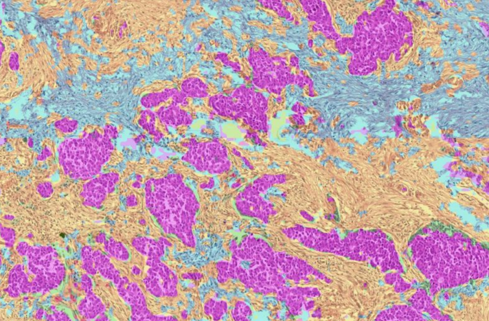 Unsupervised Semantic Segmentation for Pathology by Factorizing Foundation Model Features as an ...